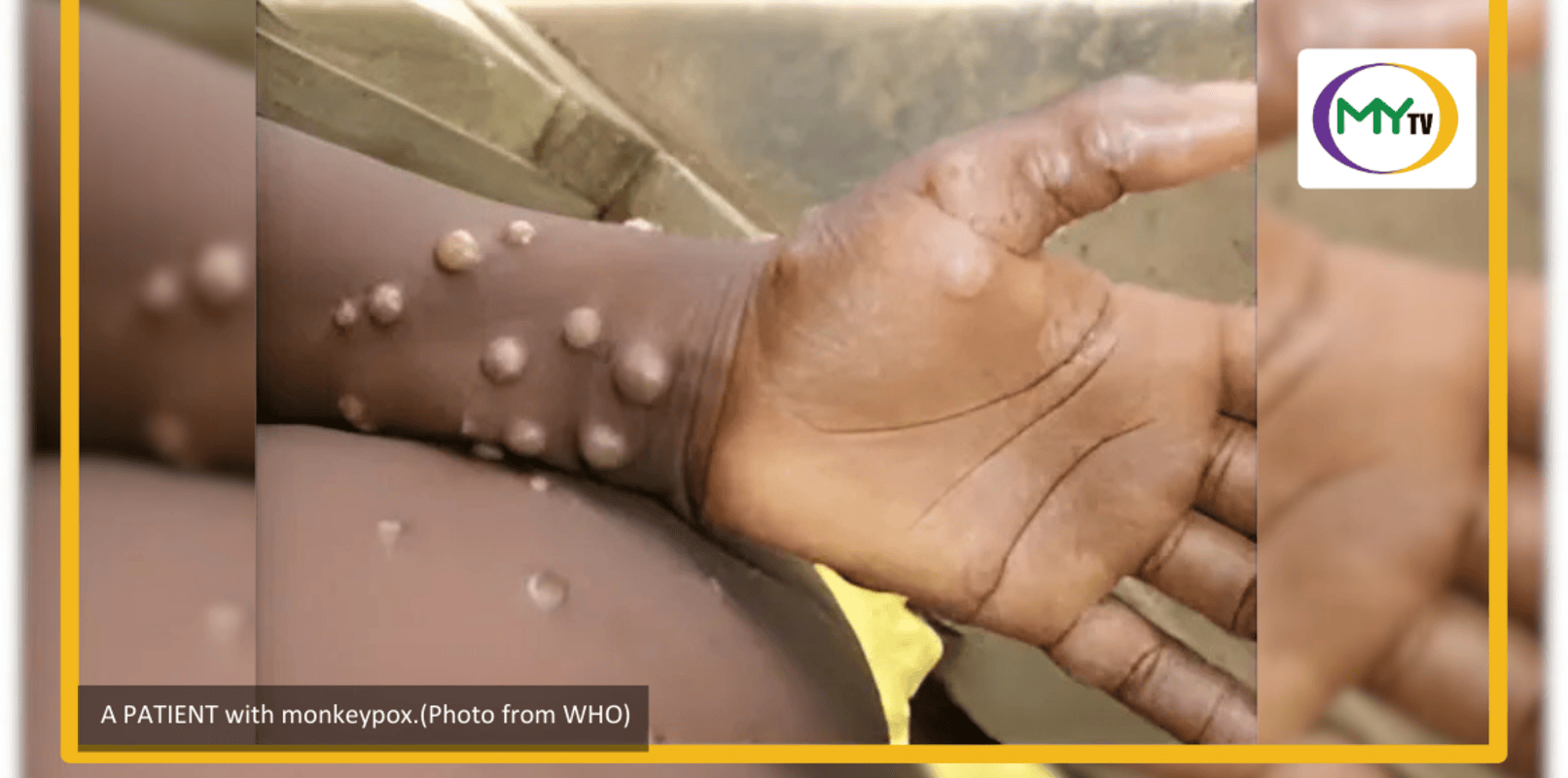 Mpox cases in PH rise to 24 | MyTV Articles